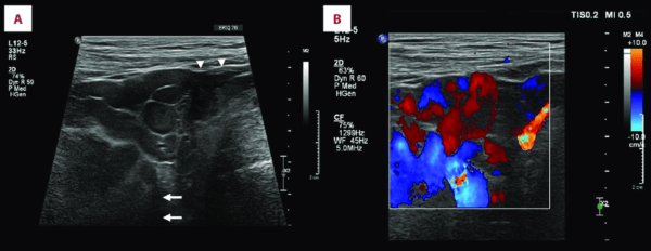 Colour Doppler Ultrasound in Pregnancy for Prenatal Care.